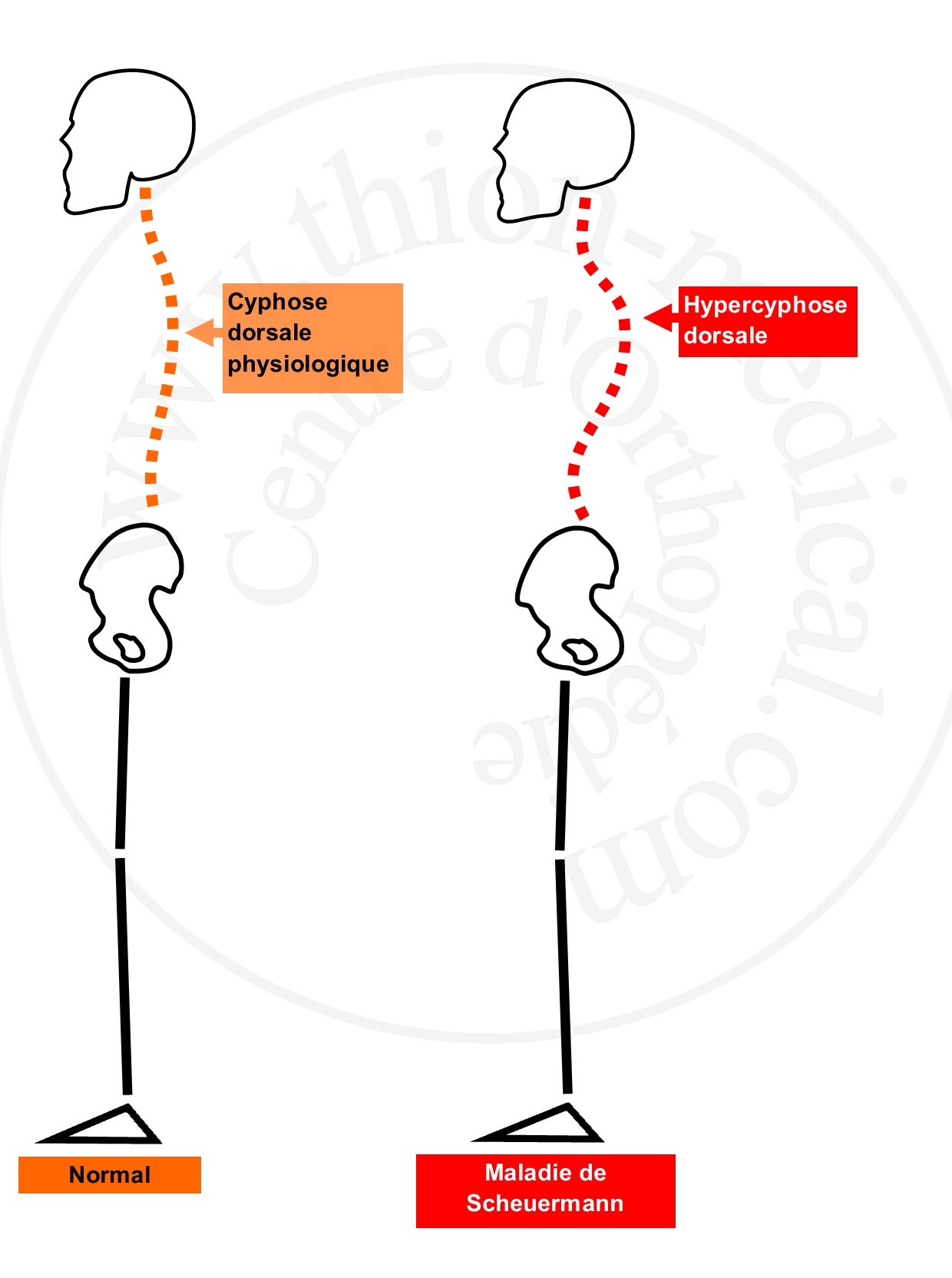 Pathologies > Pathologies du tronc > Maladie de Scheuermann